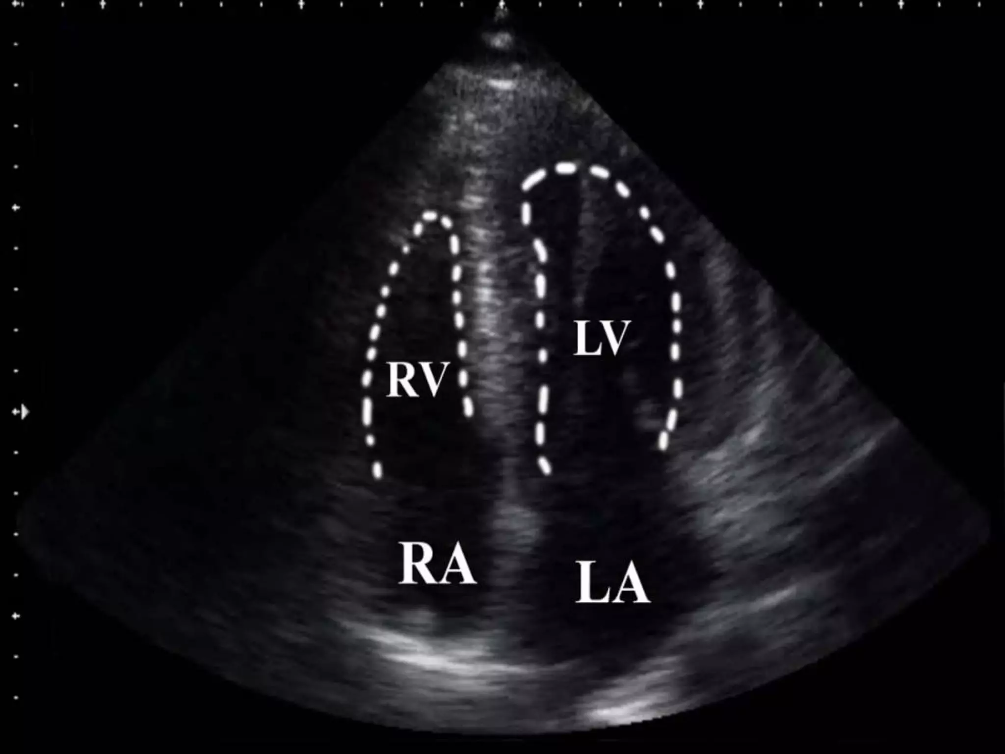 Interior of right atrium | PPTX