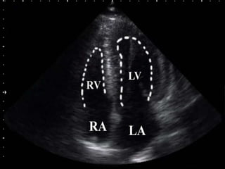 Interior of right atrium | PPTX