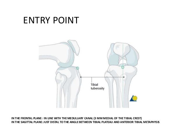 Interlocking nail of tibia