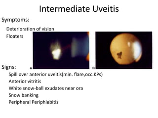 Intermeddiate & posterior uveitis dr.k.srikanth, 23.03.2016 revised | PPT