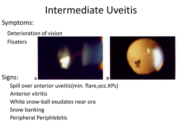 Intermeddiate & posterior uveitis dr.k.srikanth, 23.03.2016 revised | PPT