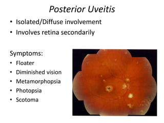 Intermeddiate & posterior uveitis dr.k.srikanth, 23.03.2016 revised | PPT