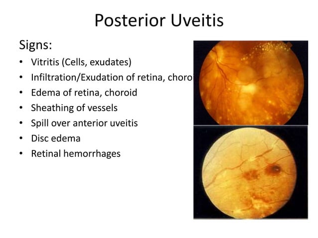 Intermeddiate & posterior uveitis dr.k.srikanth, 23.03.2016 revised | PPT