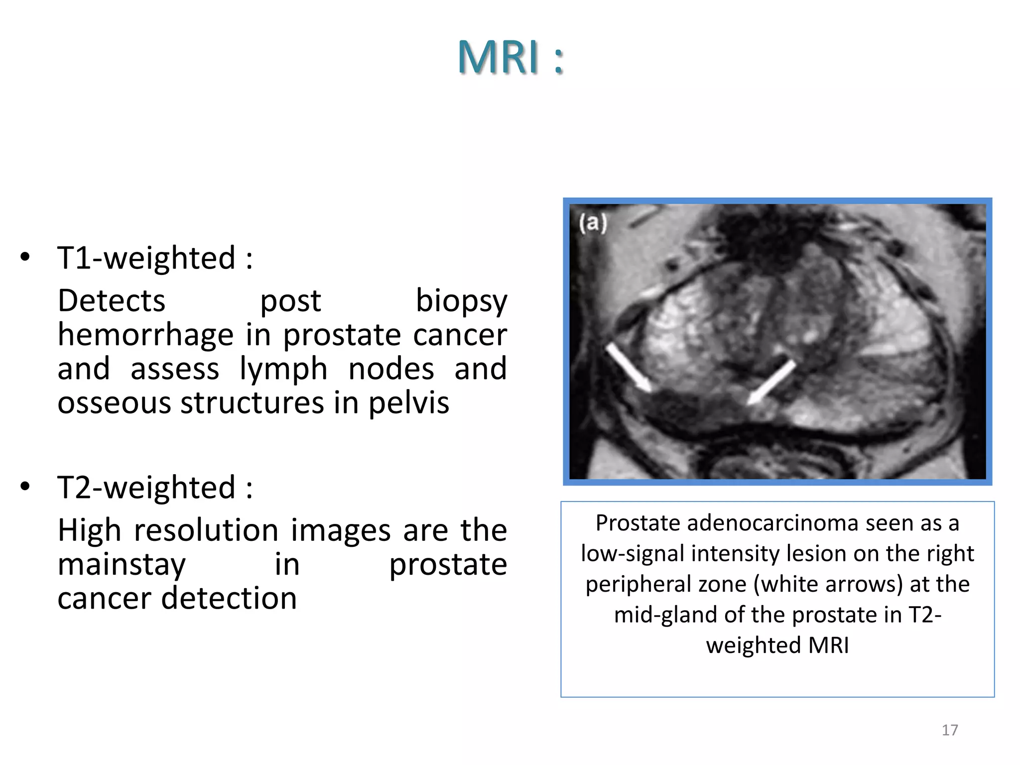 Intermediate and high risk prostate cancer | PPTX
