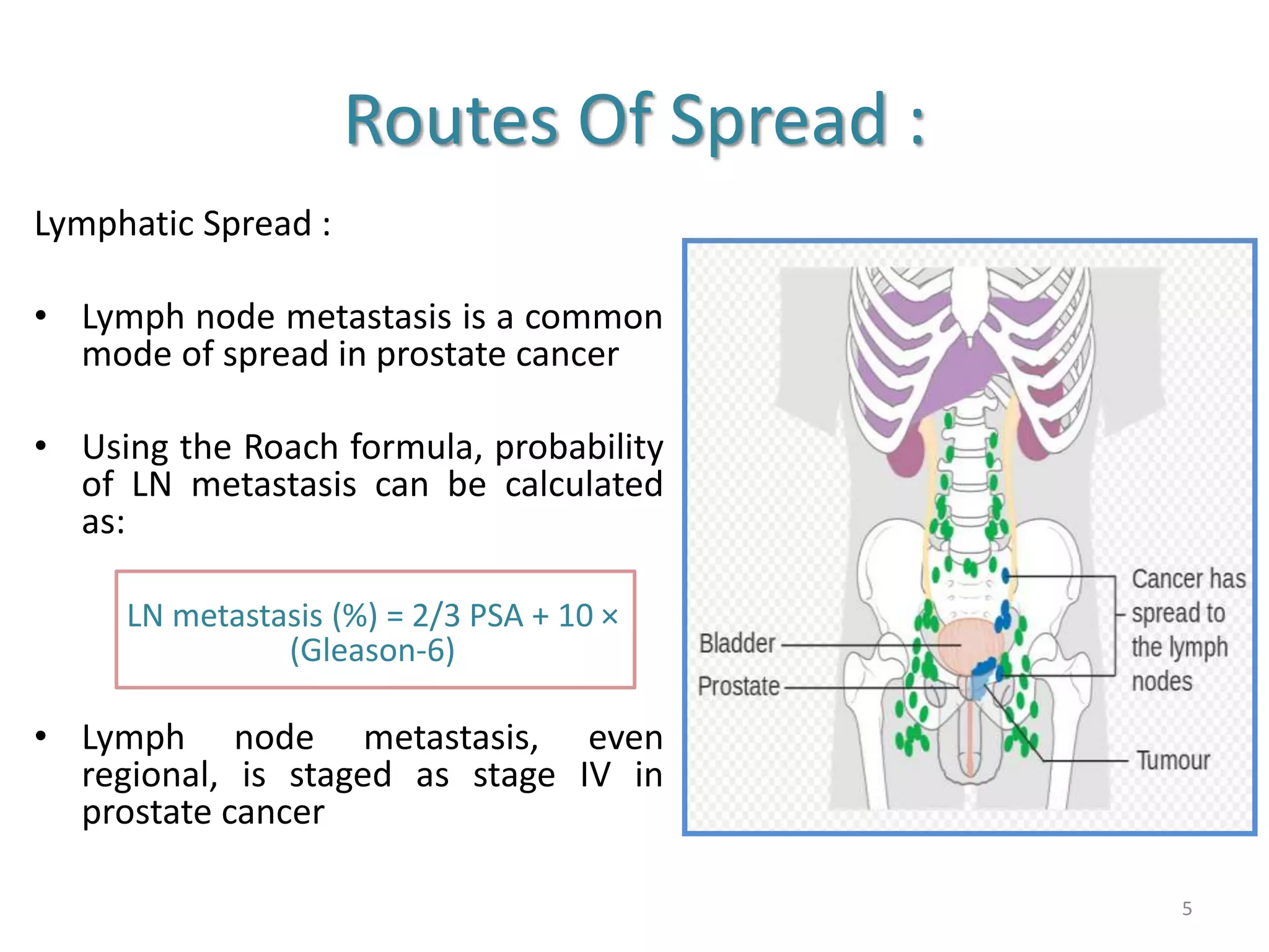 Intermediate and high risk prostate cancer | PPTX