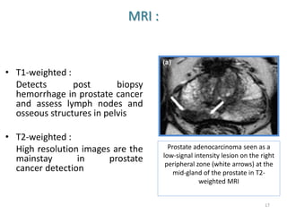Intermediate and high risk prostate cancer | PPTX