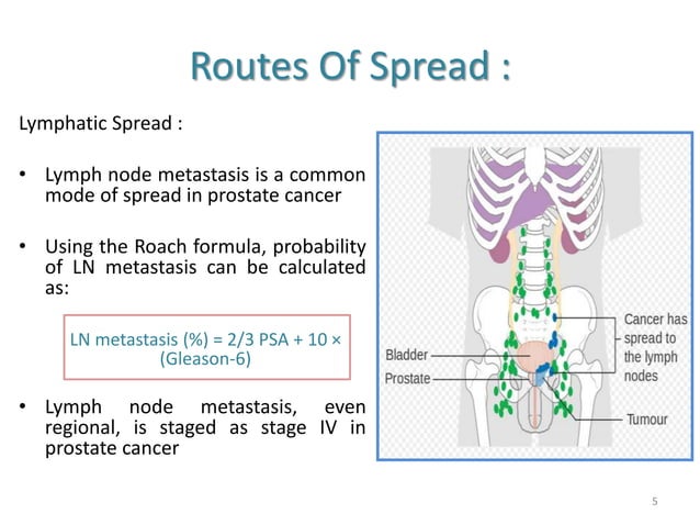 Intermediate and high risk prostate cancer | PPTX