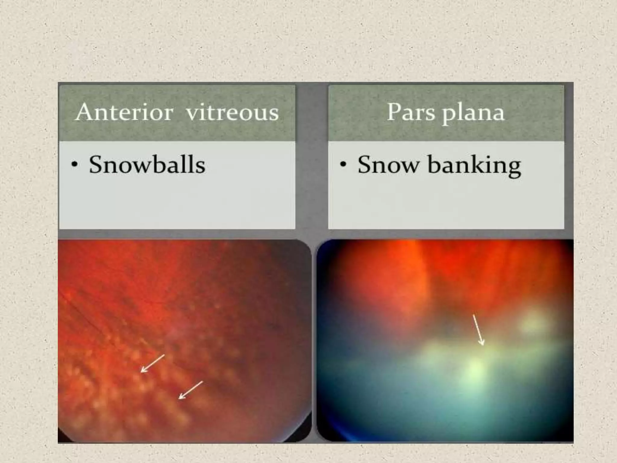 Intermediate uveitis | PPTX