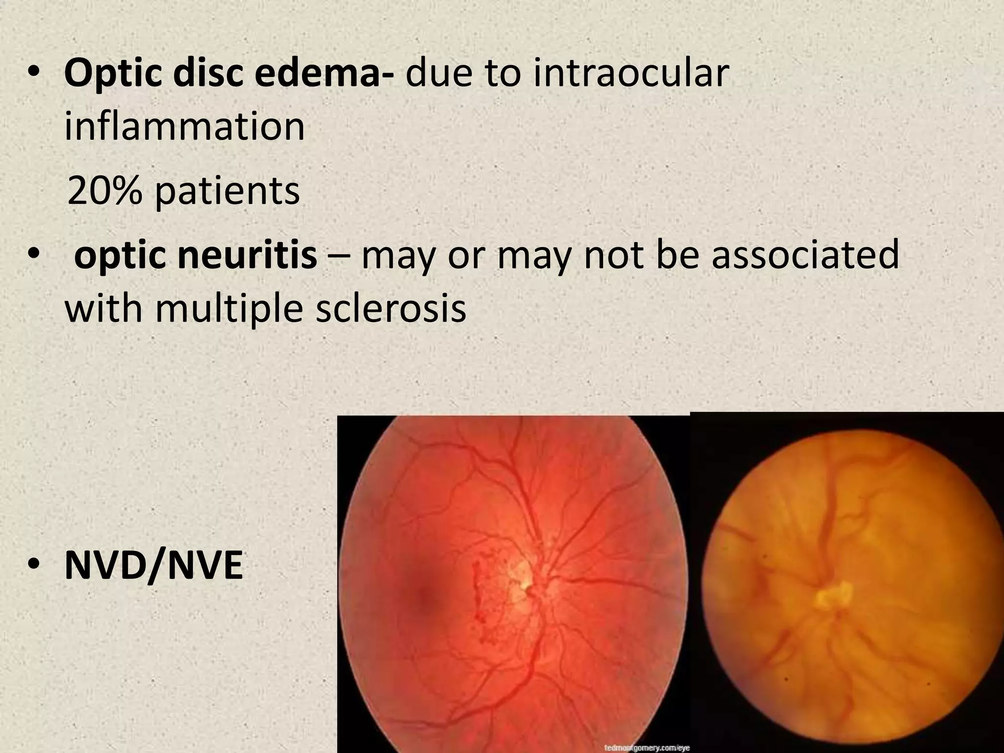 Intermediate uveitis | PPTX