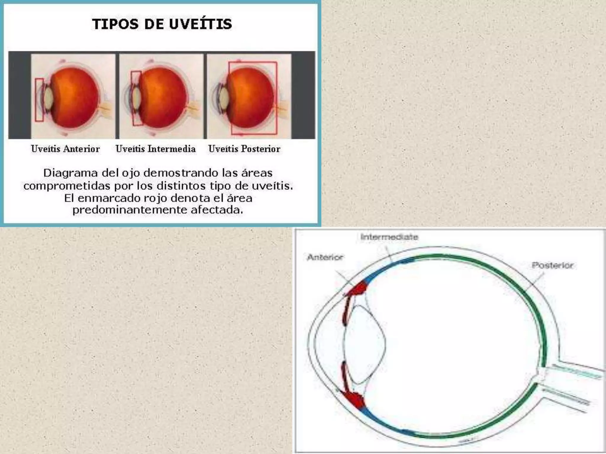 Intermediate uveitis | PPT