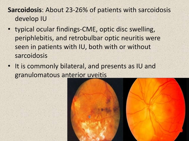 Intermediate uveitis | PPTX