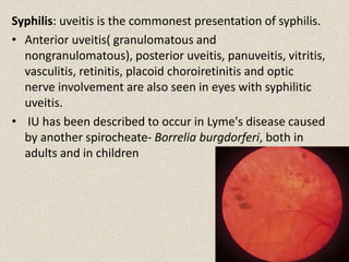 Intermediate uveitis | PPTX