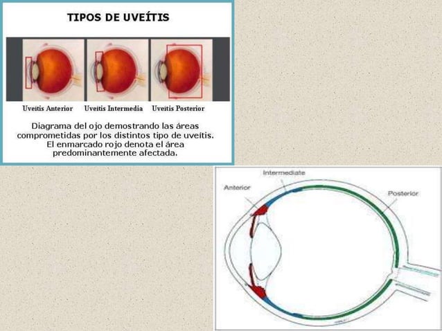 Intermediate uveitis | PPTX