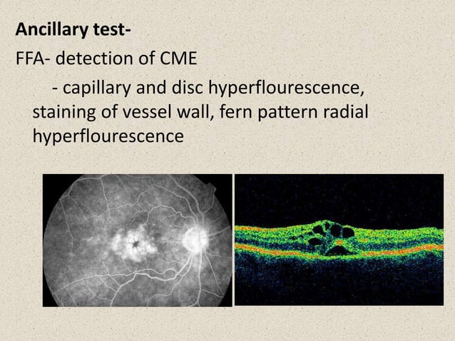 Intermediate uveitis | PPT