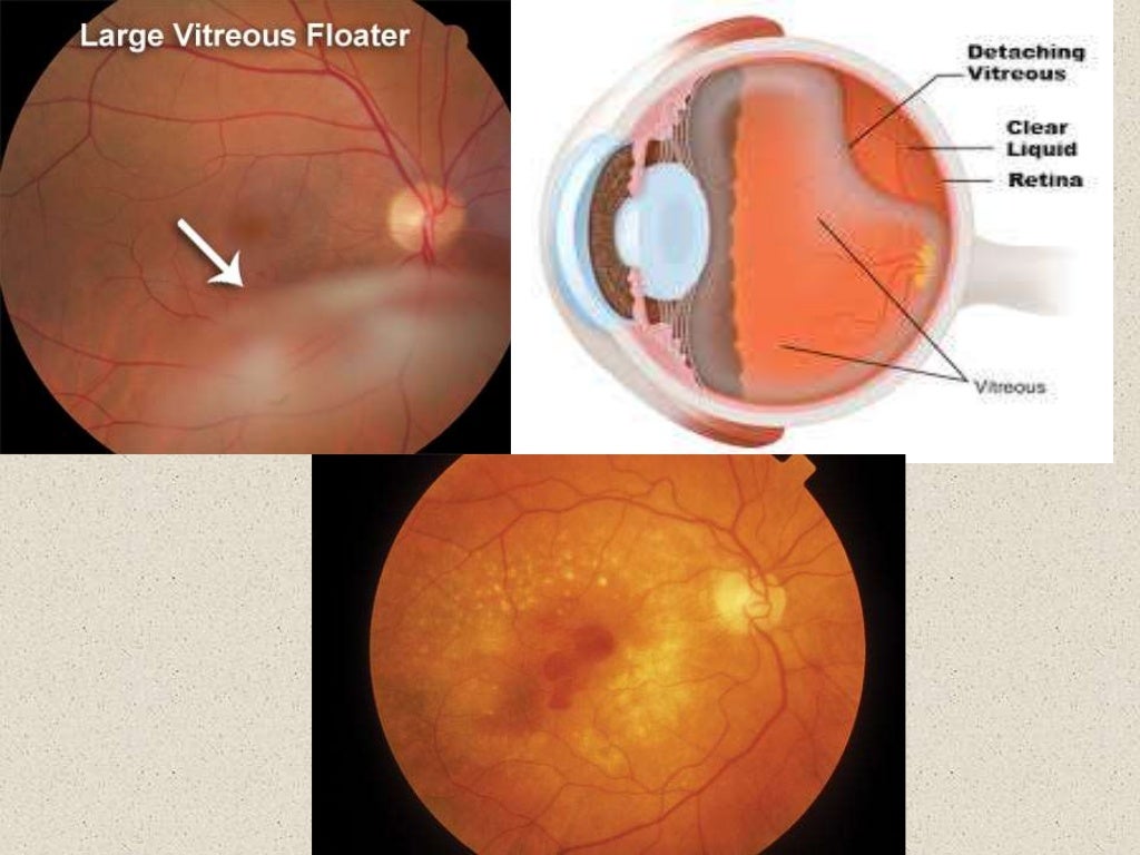 Intermediate uveitis