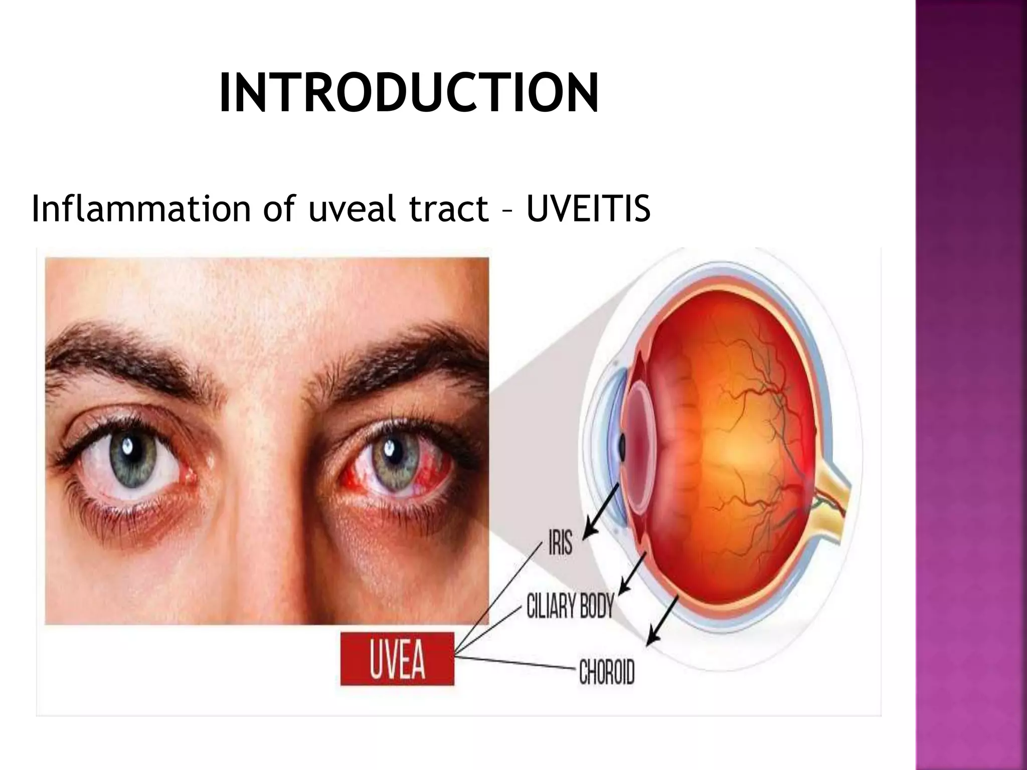 INTERMEDIATE AND POST. UVEITIS | PPTX
