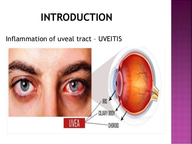 Intermediate Uveitis