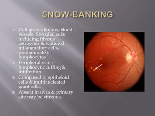 Intermediate uveitis | PPTX | Eye and Vision Conditions | Diseases and ...