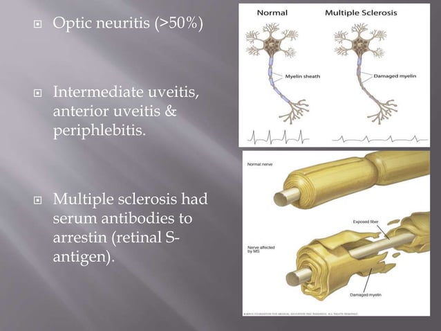 Intermediate uveitis | PPT