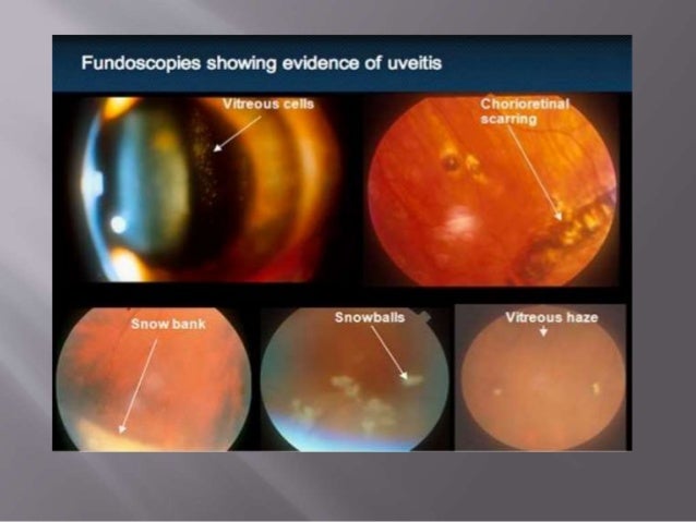 Intermediate Uveitis
