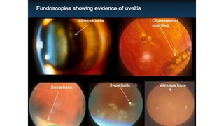 Intermediate uveitis | PPTX | Eye and Vision Conditions | Diseases and ...