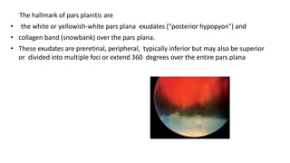 Intermediate uveitis | PPTX | Eye and Vision Conditions | Diseases and ...