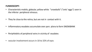 Intermediate uveitis | PPTX | Eye and Vision Conditions | Diseases and ...