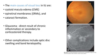 Intermediate uveitis.pptx