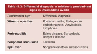 Intermediate uveitis.pptx | Eye and Vision Conditions | Diseases and Conditions