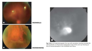 Intermediate uveitis.pptx | Eye and Vision Conditions | Diseases and ...