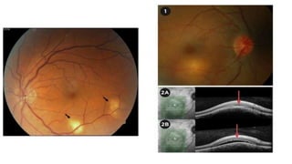 Intermediate Uveitis.pptx