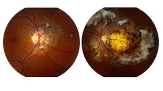 Intermediate Uveitis.pptx