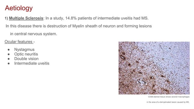 Intermediate Uveitis.pptx