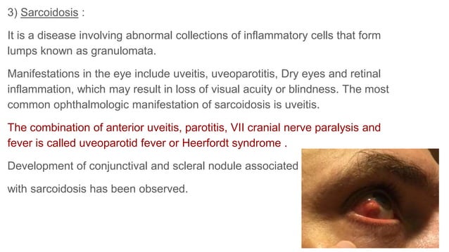 Intermediate Uveitis.pptx