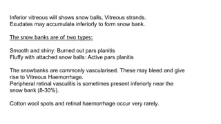 Intermediate Uveitis.pptx