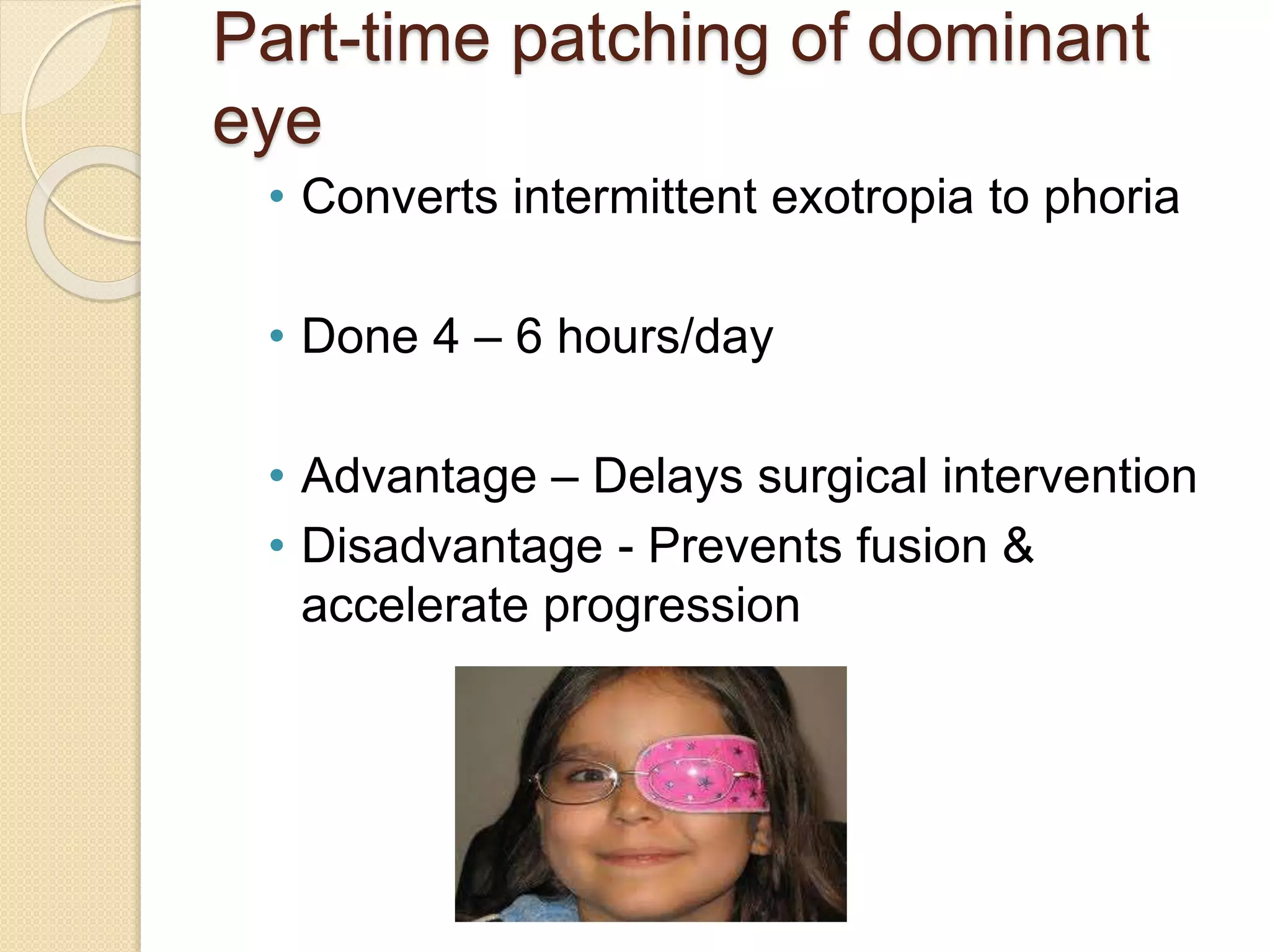 Intermittent exotropia | PPTX