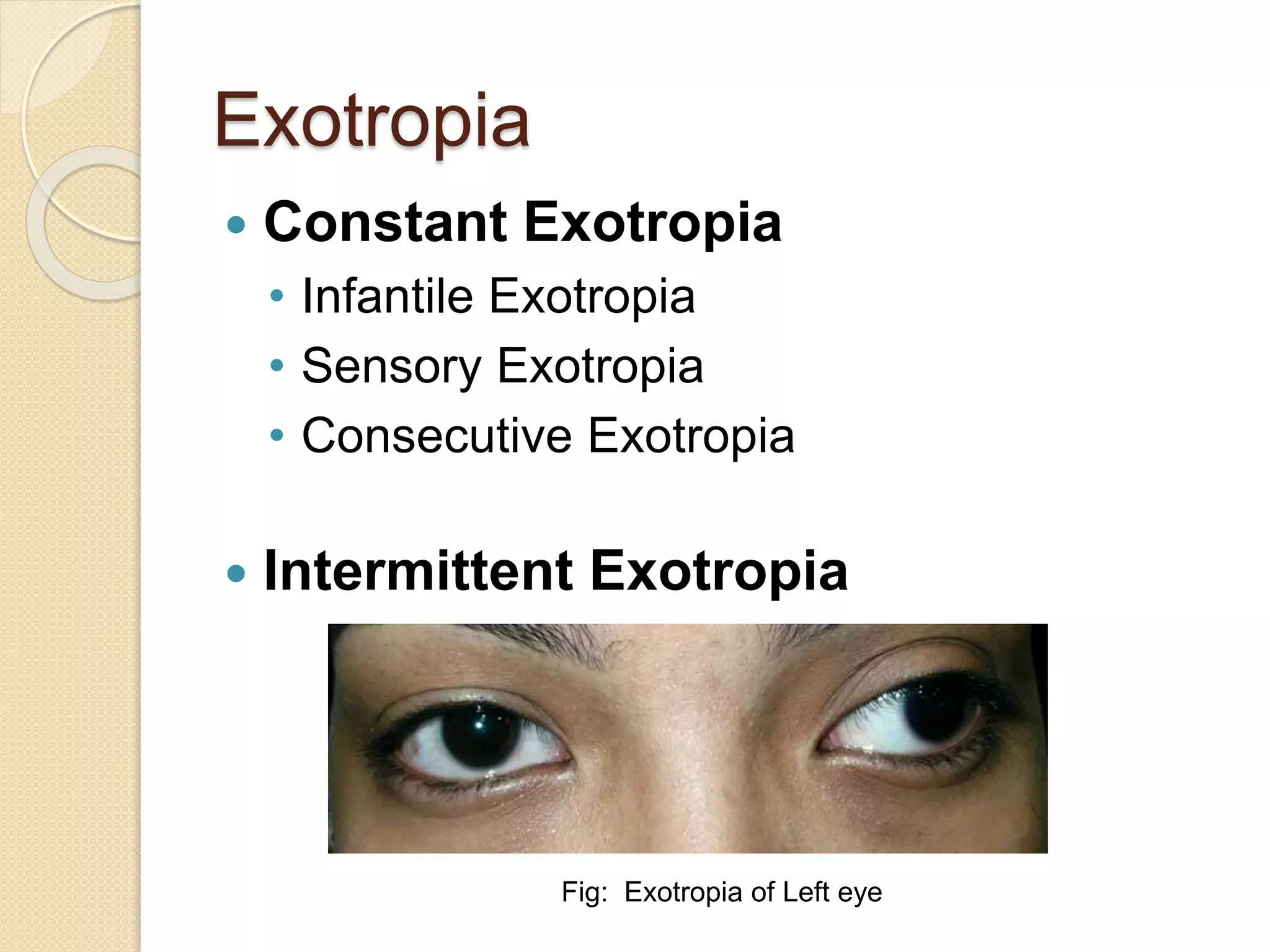 Intermittent exotropia | PPTX