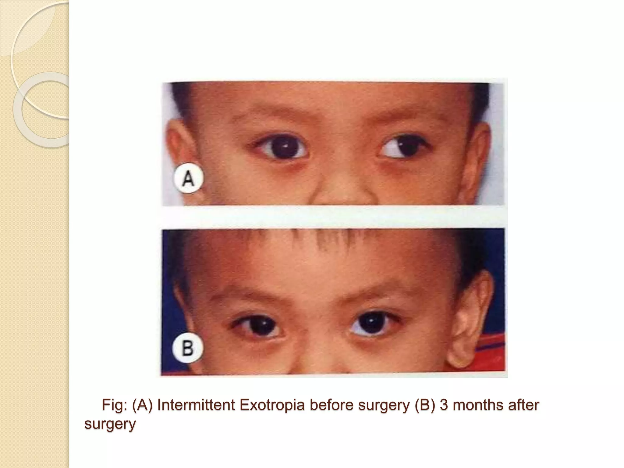 Intermittent exotropia | PPTX
