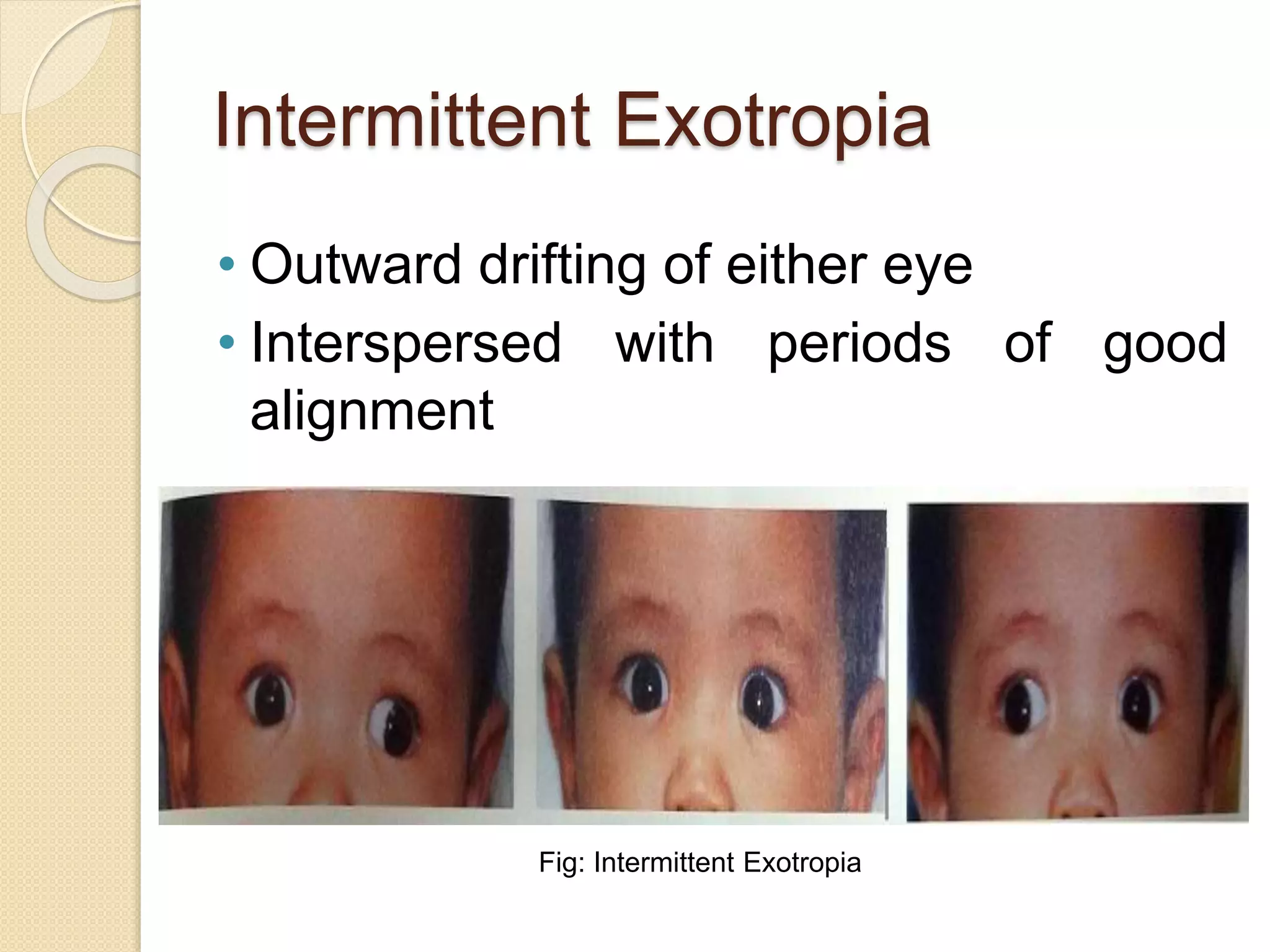 Intermittent exotropia | PPTX