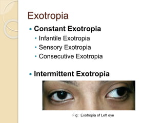 Intermittent exotropia | PPTX