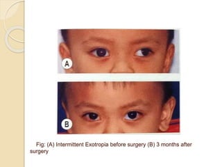 Intermittent exotropia | PPT