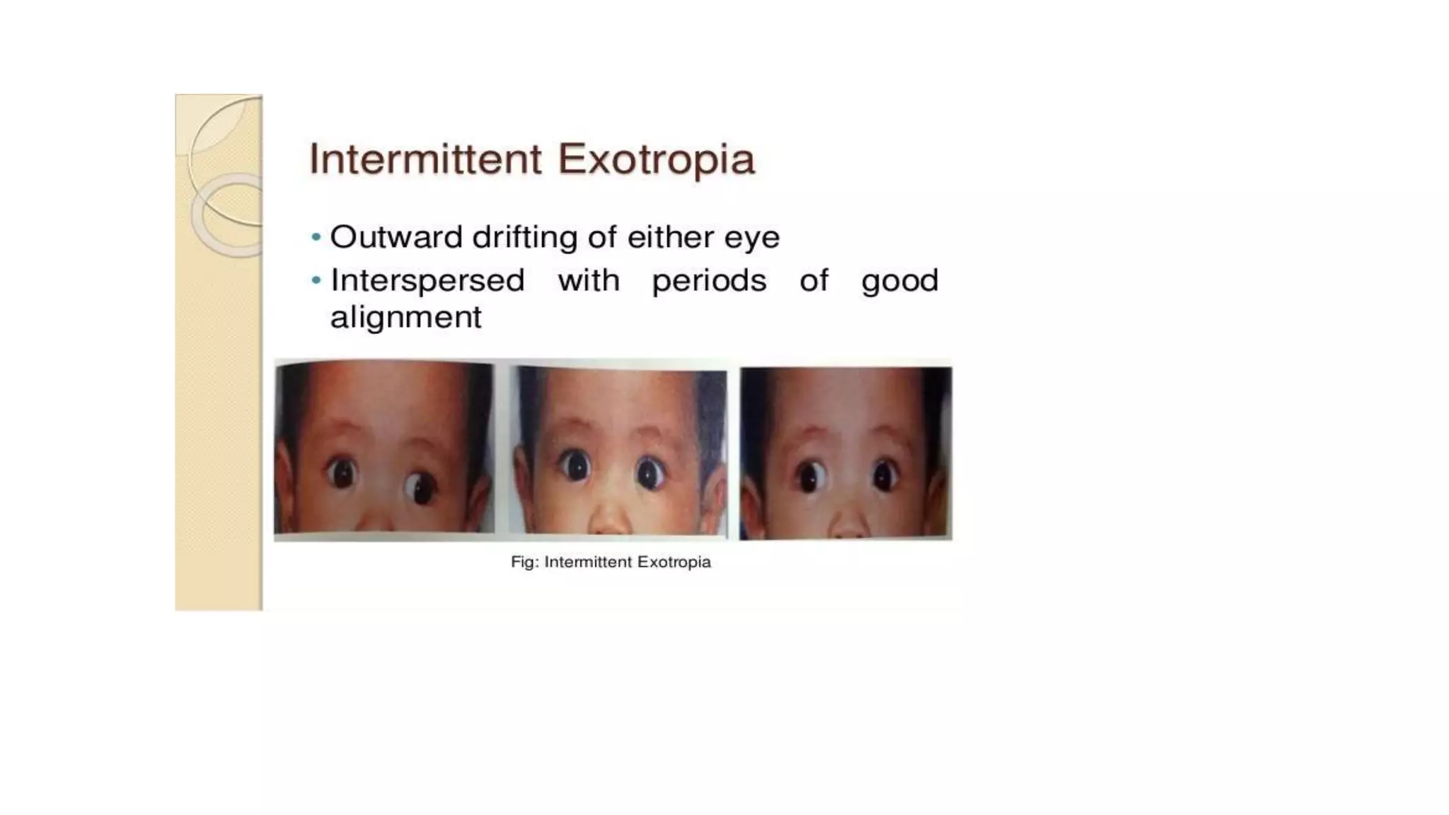 Intermittent exotropia | PPTX