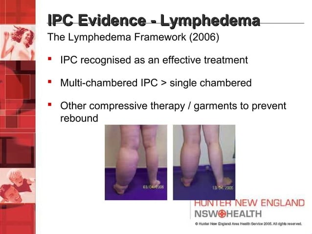 Intermittent pneumatic compression pump therapy for lymphedema • | PPT ...