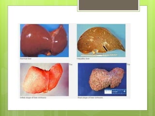 Ciroza jetre | PPTX