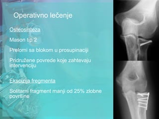 Prelom glave žbične kost | PPT