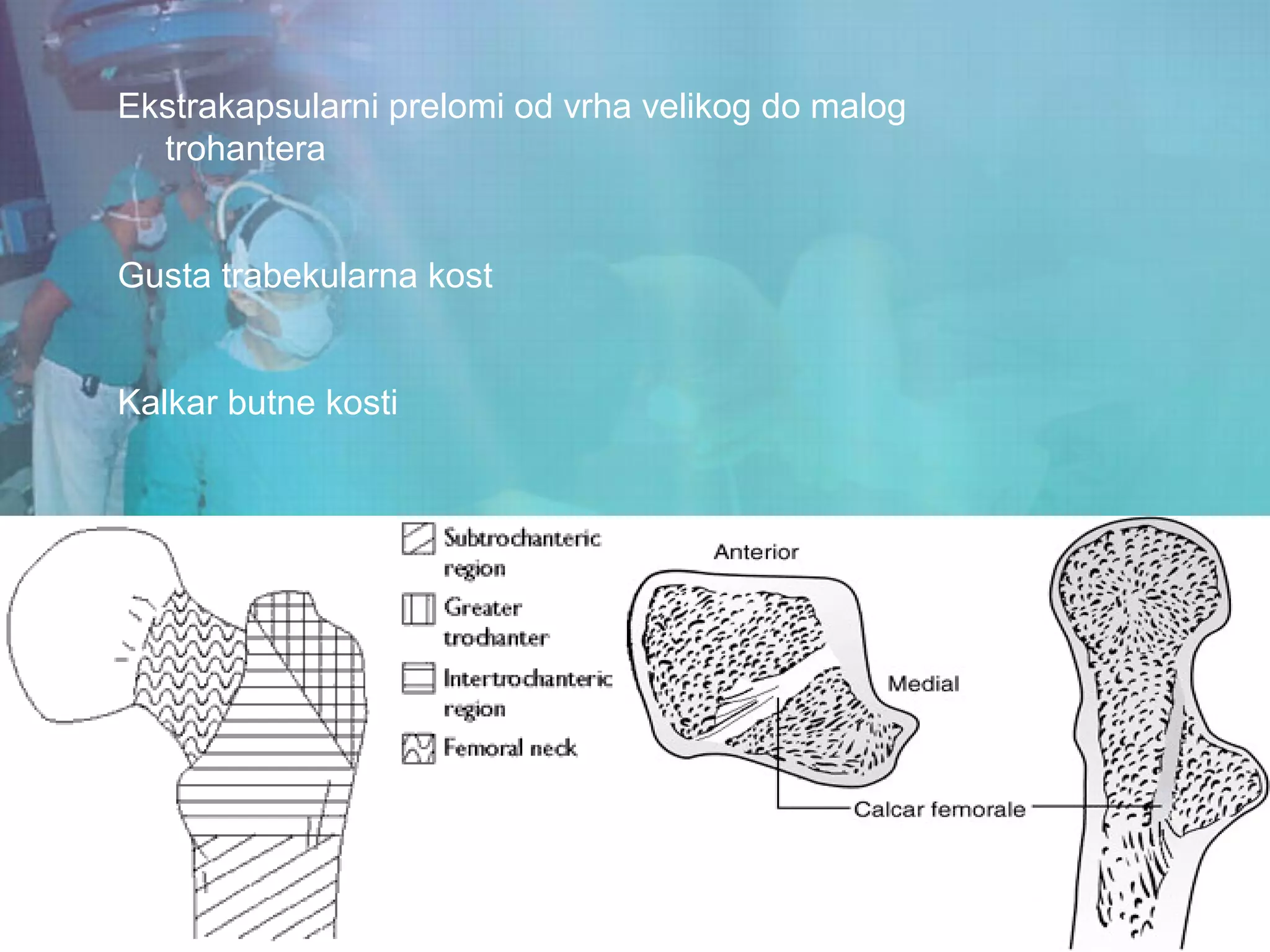 Transtrohanterni prelomi | PPT