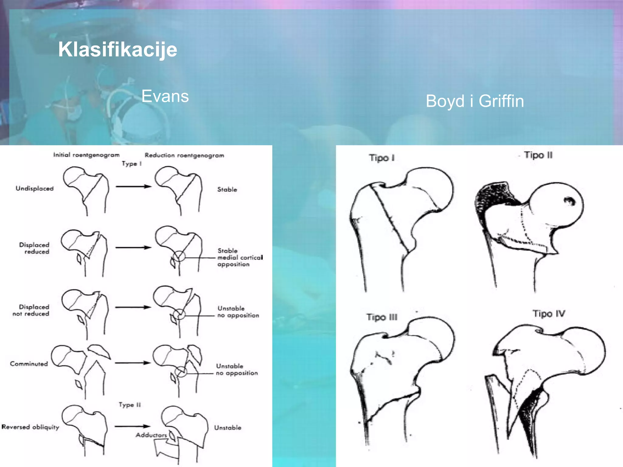 Transtrohanterni prelomi | PPT