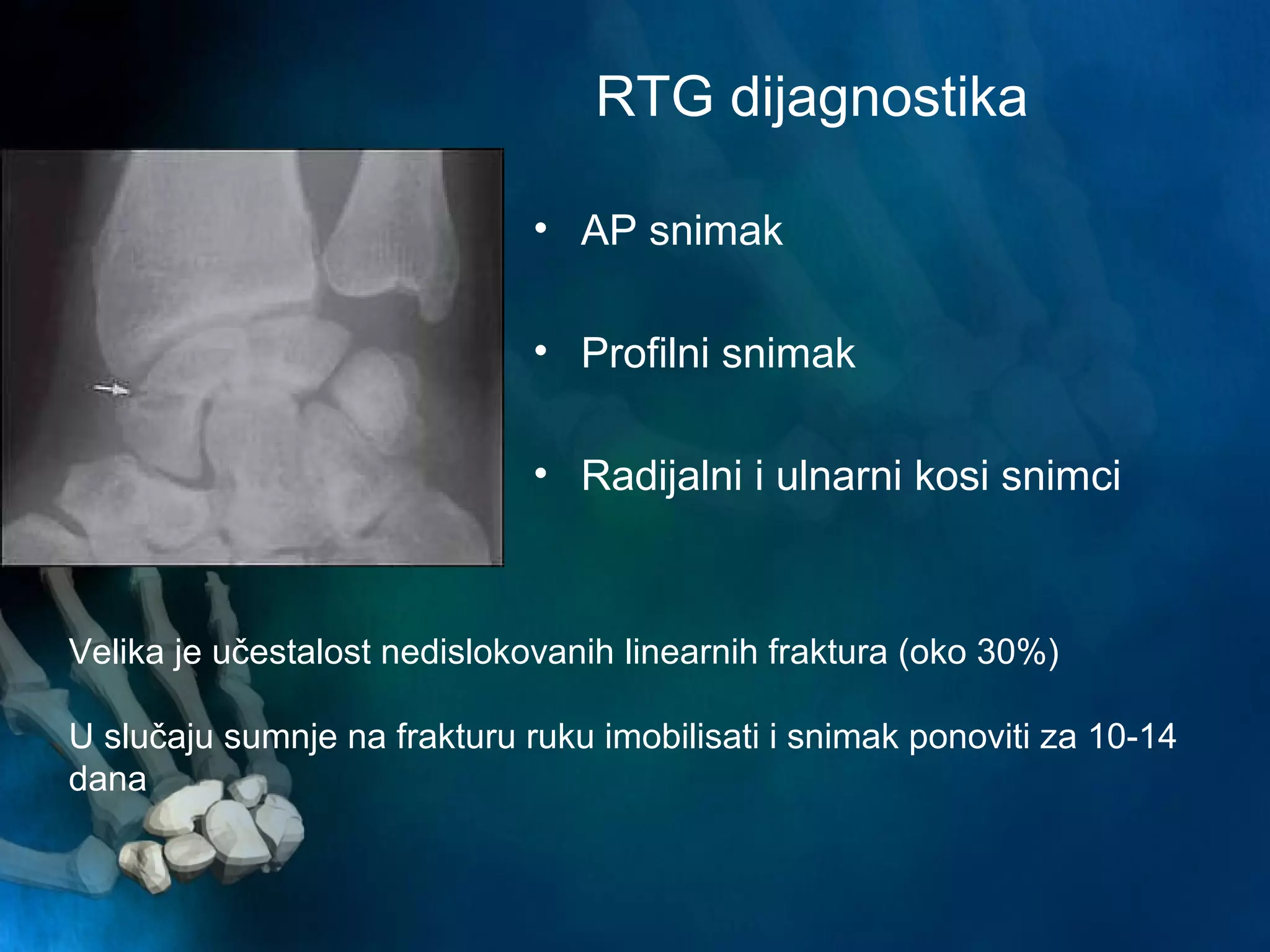Prelom skafoidne kosti | PPT
