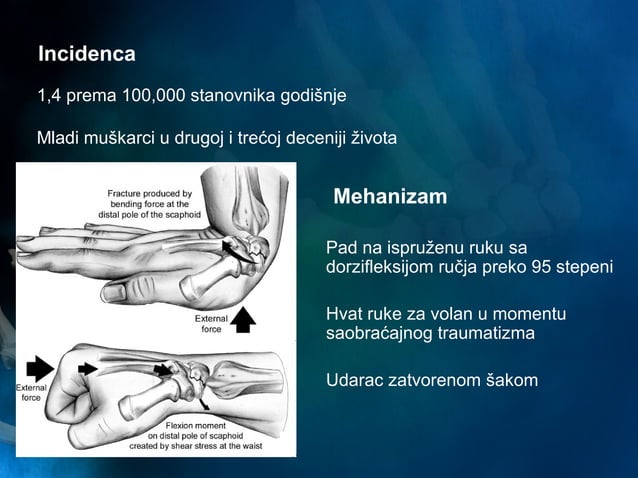Prelom skafoidne kosti | PPT