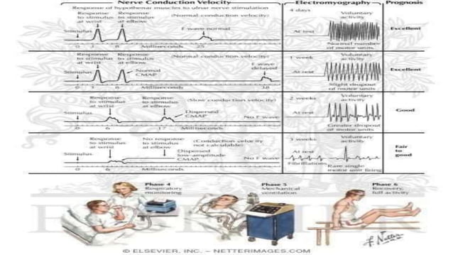 Multiple sclerosis and Gullian Barre | PPT